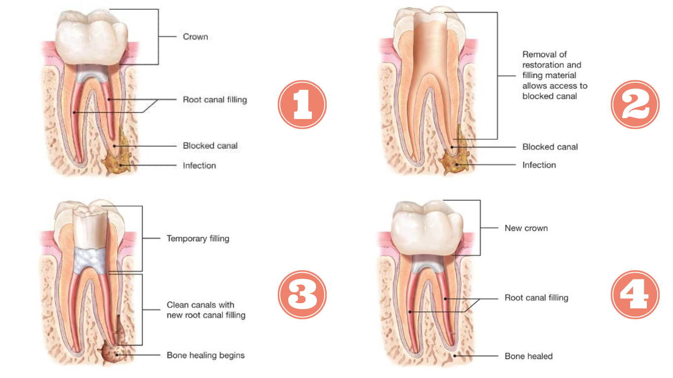 Endodontic Retreatment Endodontics East County